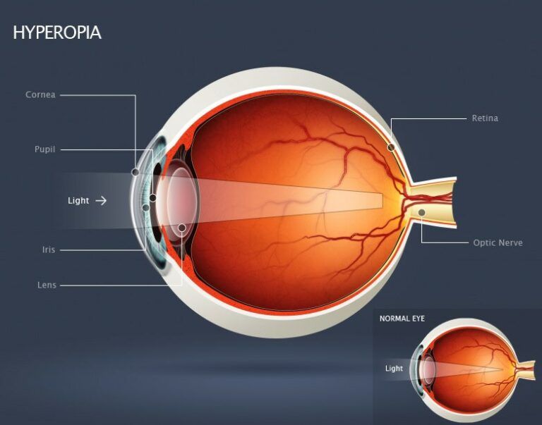 Υπερμετρωπία Τι Είναι, Συμπτώματα & Laser Θεραπεία | Δρ. Σκουτέρης