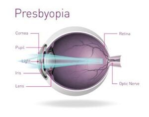 Πρεσβυωπία Συμπτώματα & Διόρθωση Laser Θεραπεία | Δρ. Σκουτέρης